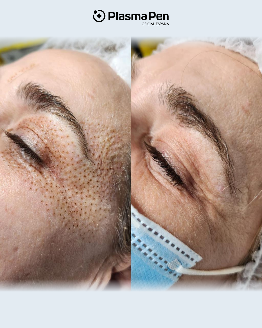Plasmapen en Párpados: El Secreto del Rejuvenecimiento sin Cirugía - Plasmapen Oficial